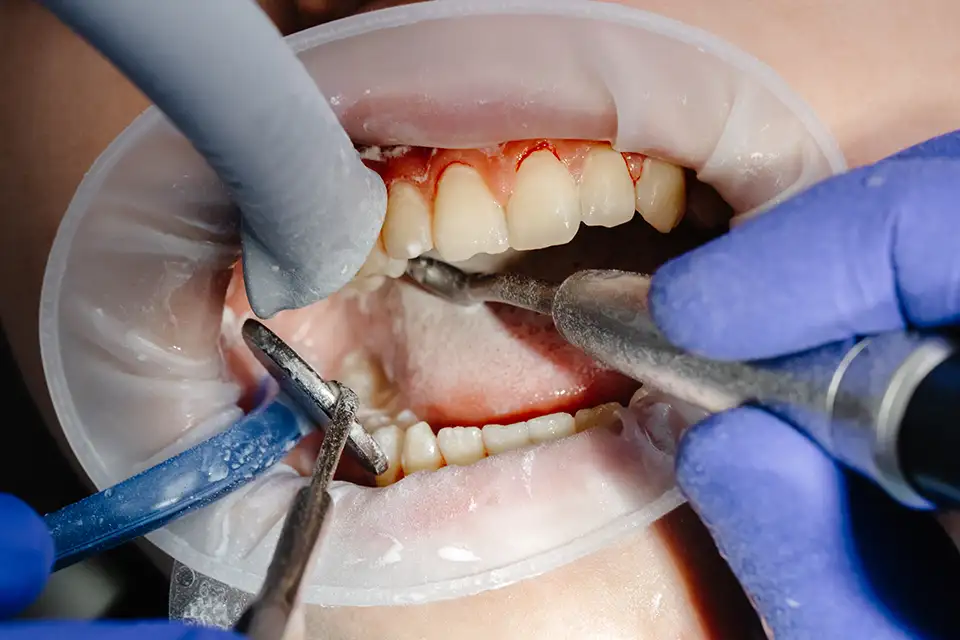 Plaque Removal Techniques - Smile Dental - St. Clair, Toronto